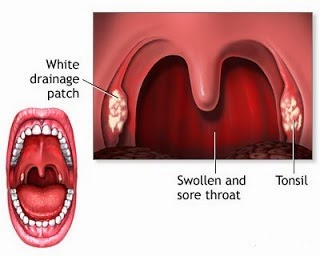 sore throat gonococcal pharyngitis | Share All Knowledge