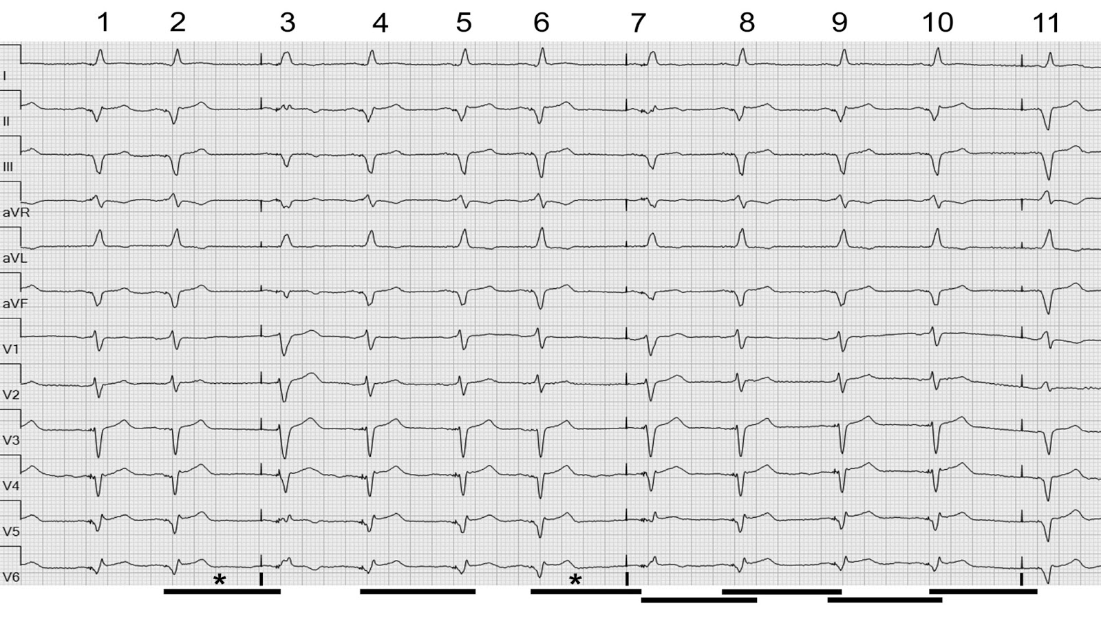Focus on ECGs: Case #12 — Varying Morphology of QRS Complexes: A ...