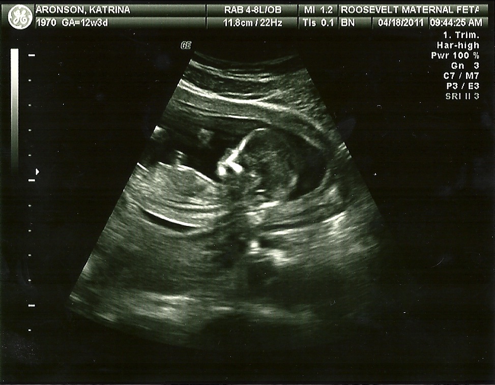 pregnantista: hospital sonogram (nuchal translucency) - 13 weeks