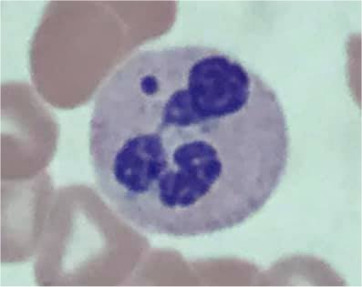 A Dull Day At Work...?: 31 January 2019 (Thursday) - Neutrophil Inclusions
