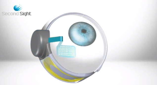 FDA Approves Argus II - First Bionic Eye | THE OFFICIAL ANDREASCY ...
