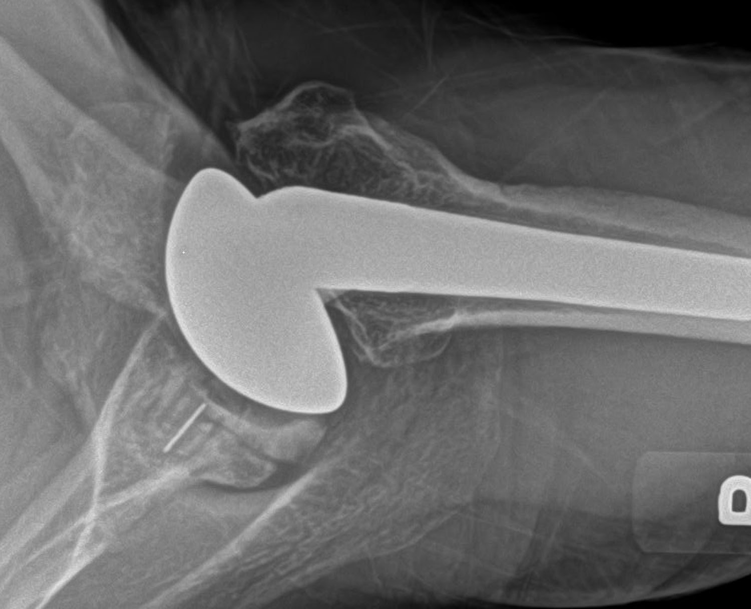 Shoulder Arthritis / Rotator Cuff Tears / Shoulder Pain : Shoulder ...