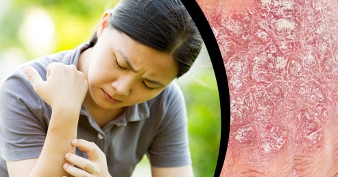 Psoriasis: Top 10 des causes, des déclencheurs et des traitements