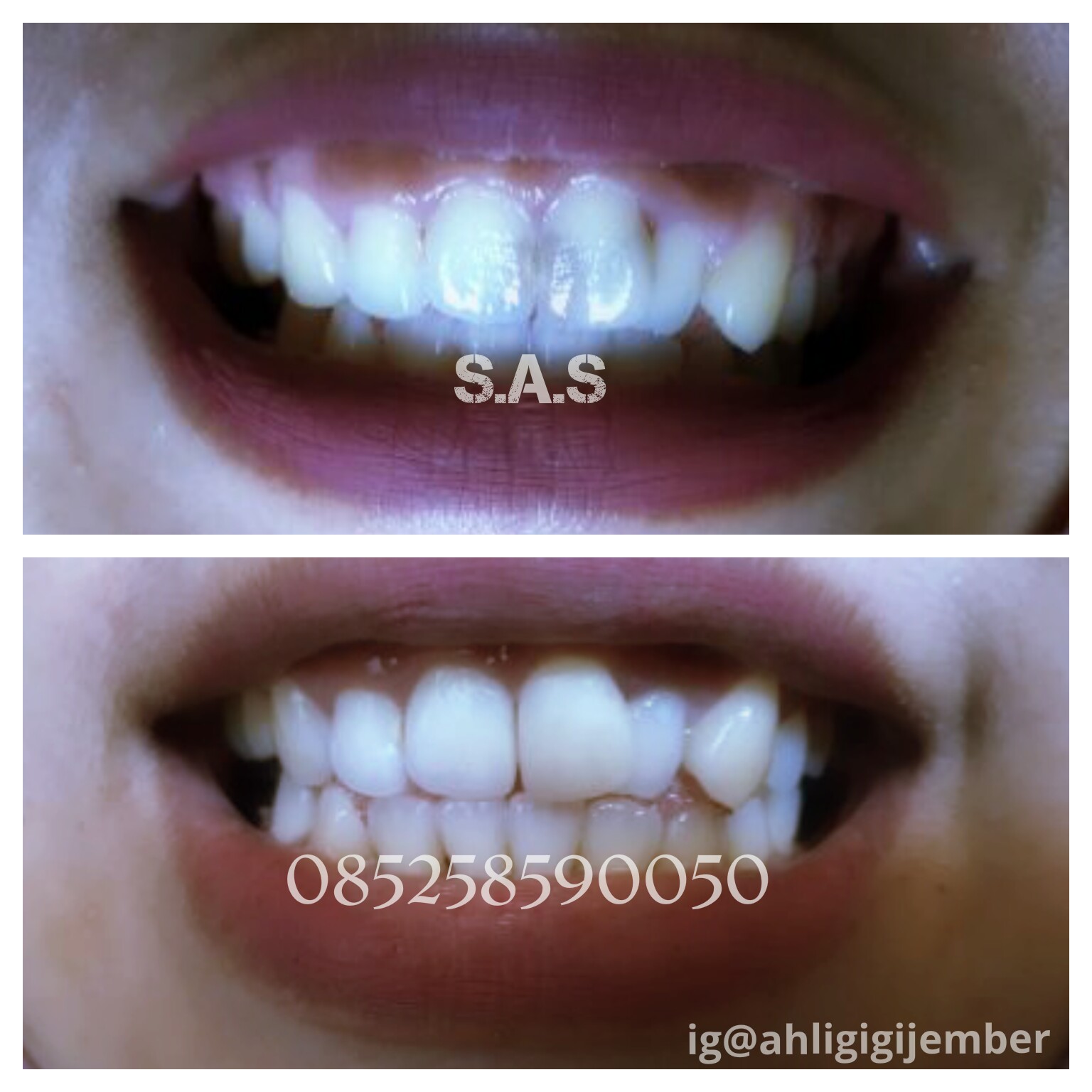 Foto Hasil Perbaikan Gigi Keropos, Berlubang Hitam Hingga Gigi Rapi dan ...