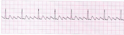 Atrial Fibrillation and Atrial Flutter