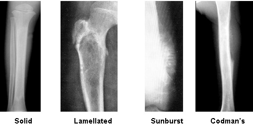 Dr Herry Setya Yudha Utama SpB. FInaCS. MHKes. ICS: Malignant Bone ...