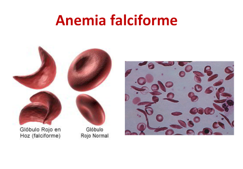 MI ANEMIA FALCIFORME Y YO