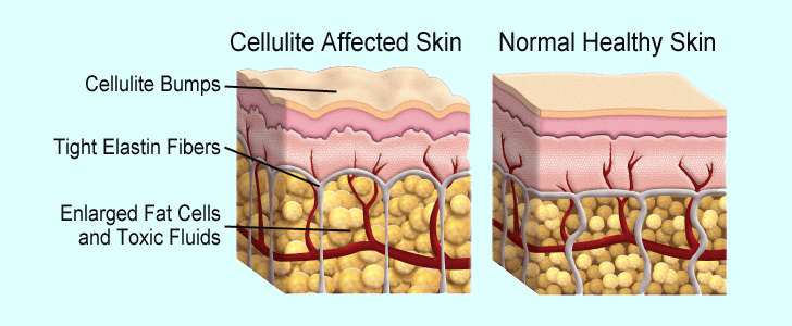 4 Ways the Best Cellulite Treatment - Cellulite Treatment News