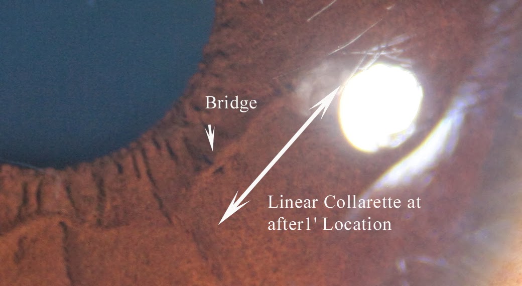 Modern & Multidimensional Iridology: The Collarette Structure - Rx ...