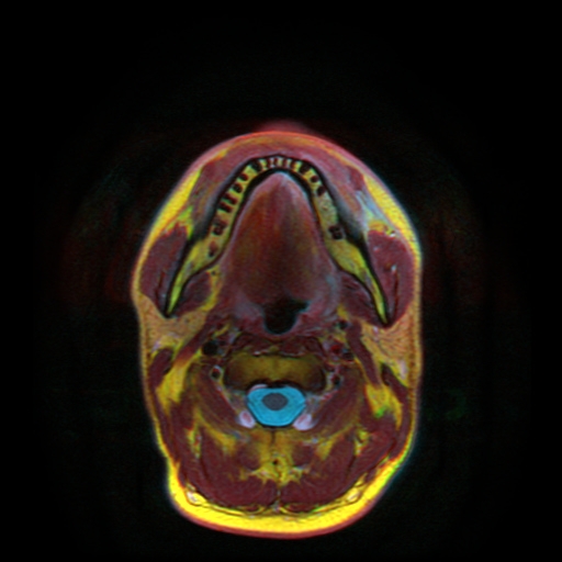 Nevit's blog: Color MRI of the Neck