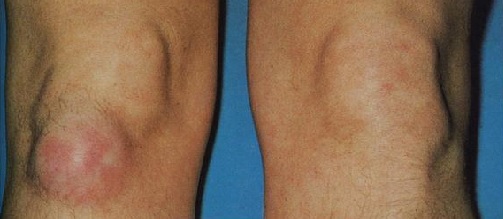 Rodilla y cadera: Bursitis de rodilla