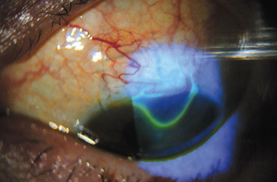 zonaprofesional: Exploración con Lámpara de Hendidura