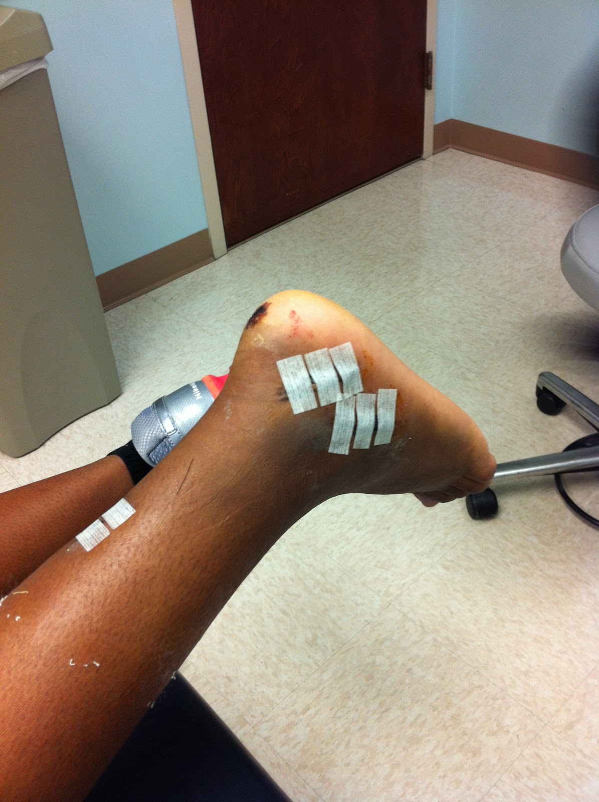 A Runner's Life: REDEFINED: Day 13: First Post-Op Appointment w/ new ...