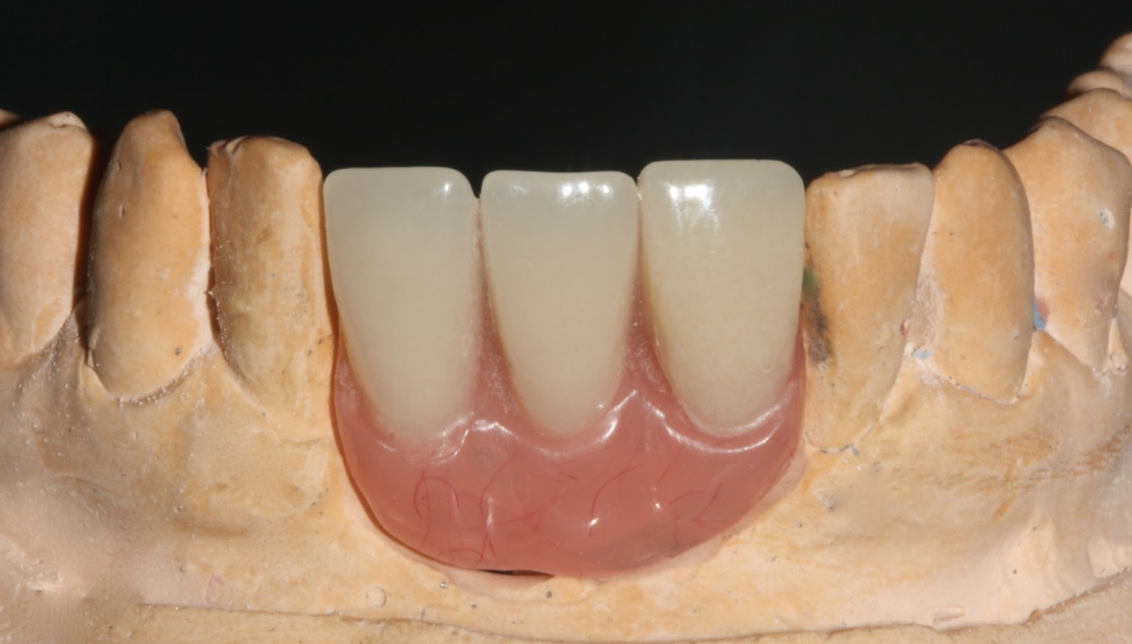 Rehabilitación antero-inferior mediante prótesis mini-híbrida ~ CYBEL