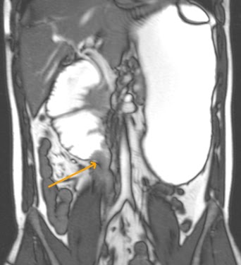 mricases: Intestinal malrotation with duodenal obstruction secondary to ...