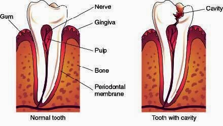 Asnan pro: Reversible Pulpitis Vs Irreversible Pulpitis
