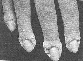 PUBLIC HEALTH: VERRUCA A SKIN DISEASE