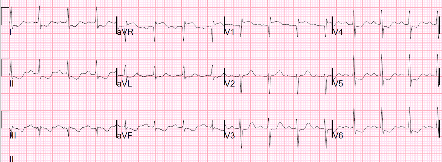 St Elevation Depression