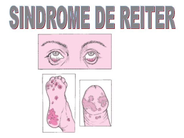 SINDROMES ~ CONSULTAS MEDICAS ONLINE