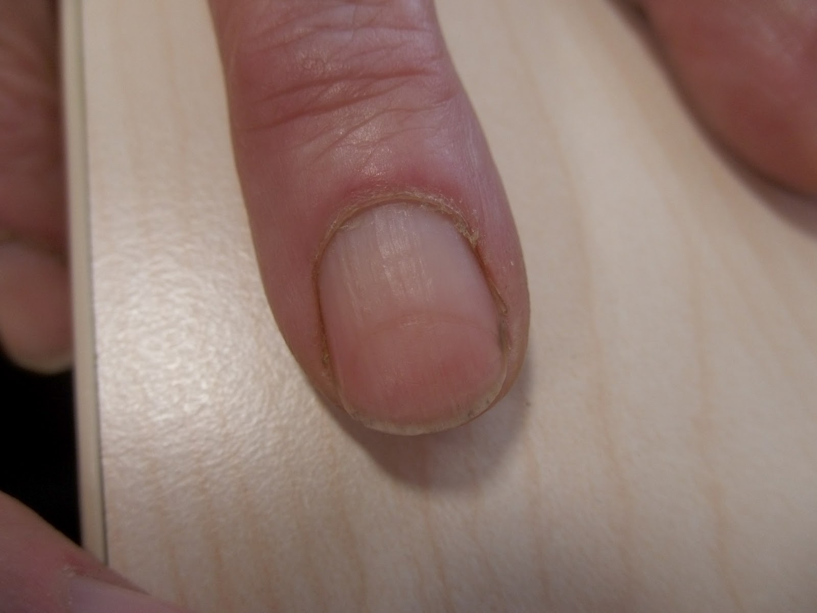 Rheumatologe: Trophic disturbance in nail growth