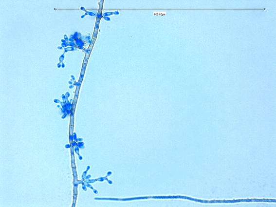 Fun With Microbiology (What's Buggin' You?): Fonsecaea pedrosoi/monophora