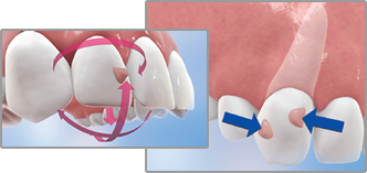 RiteBite Orthodontics: Waterloo Orthodontist on Invisalign G4