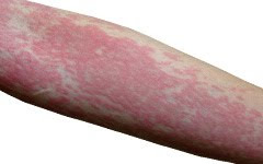 How to Cure Angioedema & Hives | humandiseasescure