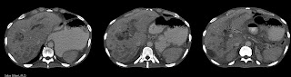 Roentgen Ray Reader: Cavernous Transformation of the Portal Vein