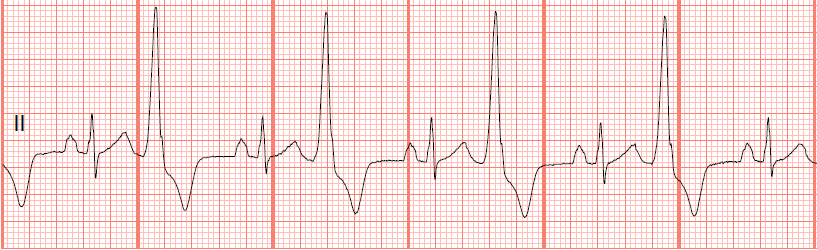 Basic EKG Rhythm Test 45
