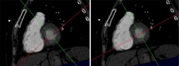 Chest Section: 2-CT Cardiac axis