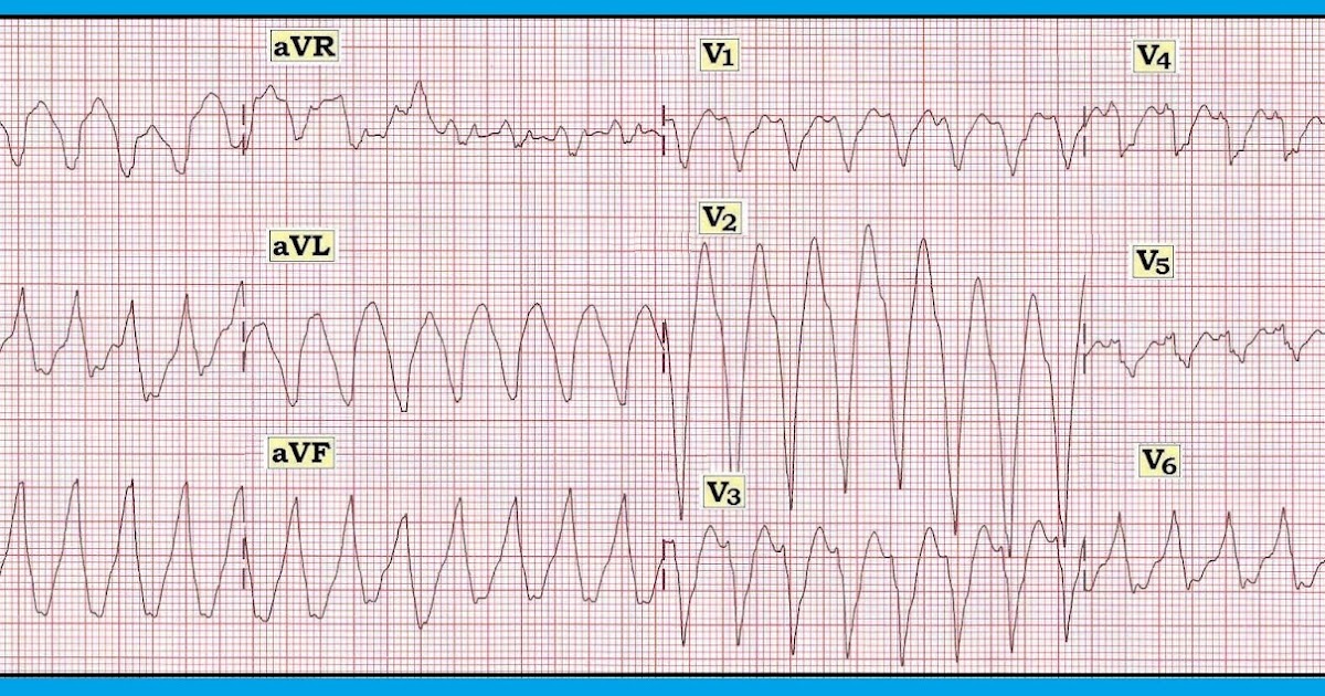 ECG Interpretation: ECG Interpretation Review #42-BIS (Tables and ...