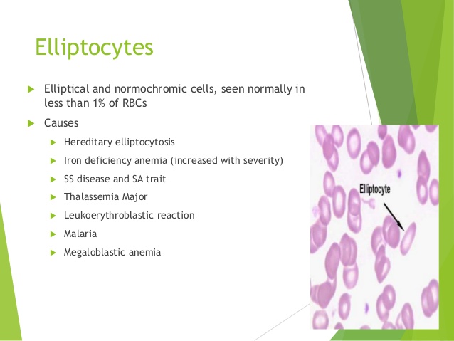 Hello USA: elliptocytes