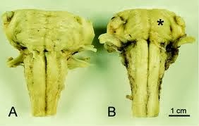 Medical Treatment Pictures-for Better Understanding: Machado-Joseph Disease