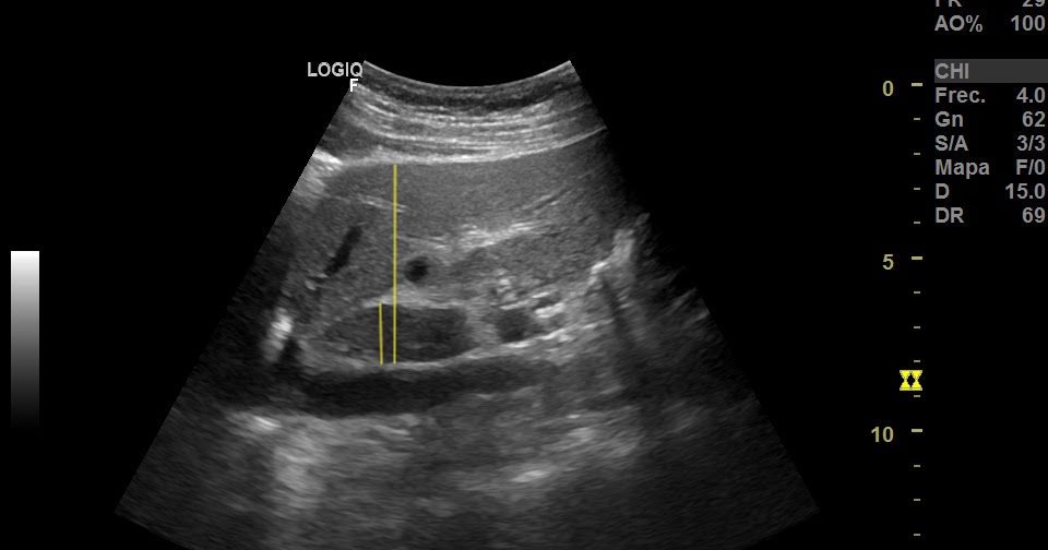 Ecografía en Atención Primaria: HEPATOMEGALIA.... ¿cómo se comprueba?