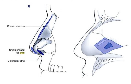 Nose Revision Surgery and Surgeons: The mystery of all the different ...