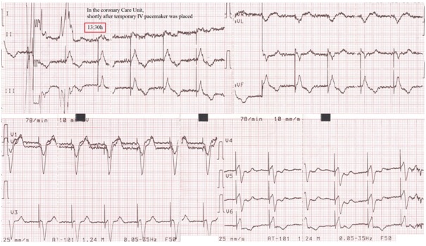ECG Rhythms: Extreme supraventricular bradycardia