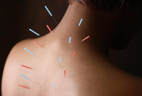 Benefits of Acupuncture | Health and Personal Care