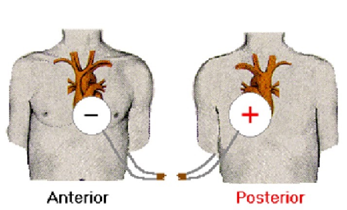 ACLS review: Bradycardia part 4
