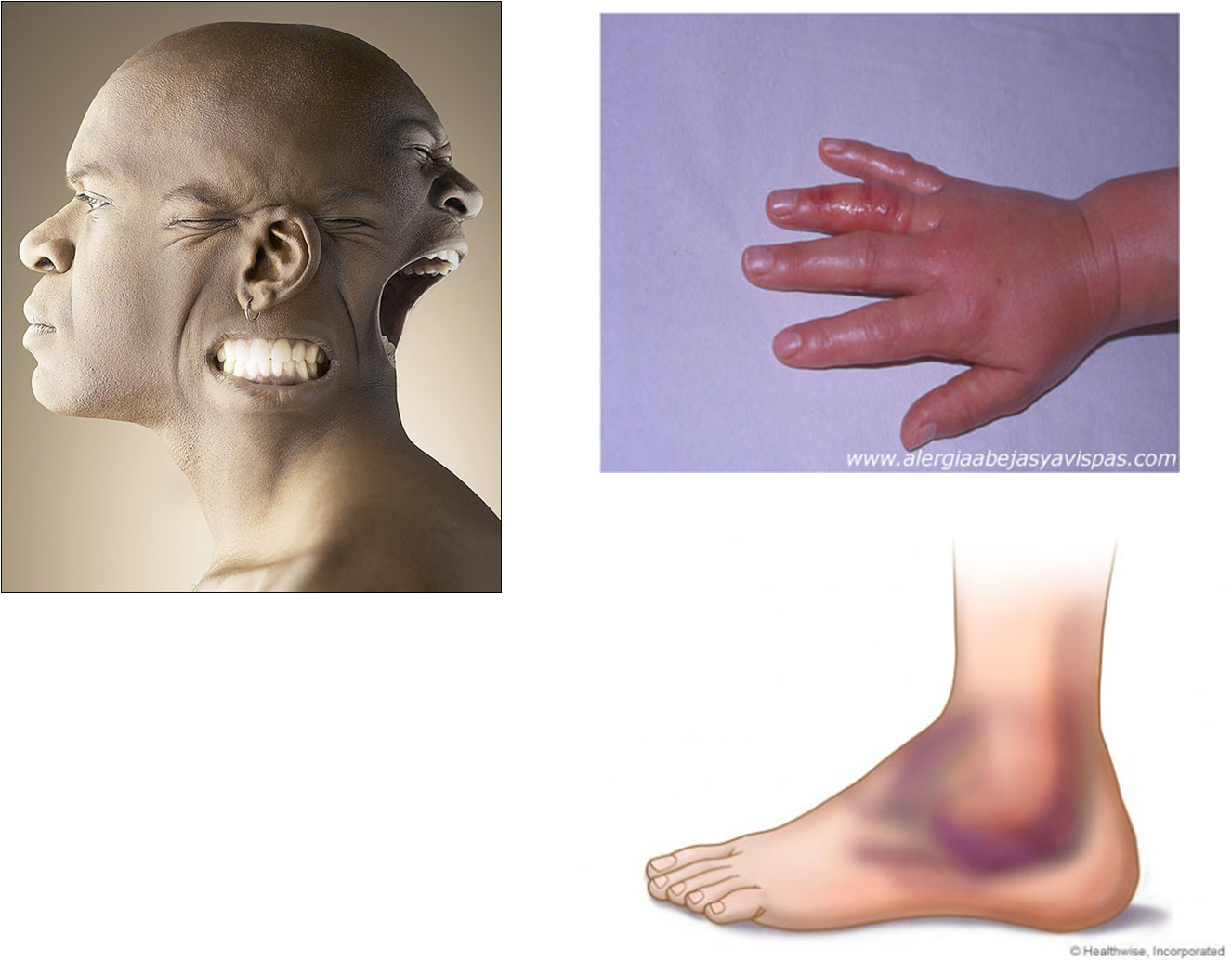 HERIDAS: HERIDAS Y CONTUSION