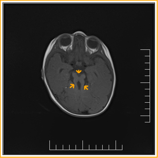 Joubert's Syndrome-MRI - Sumer's Radiology Blog