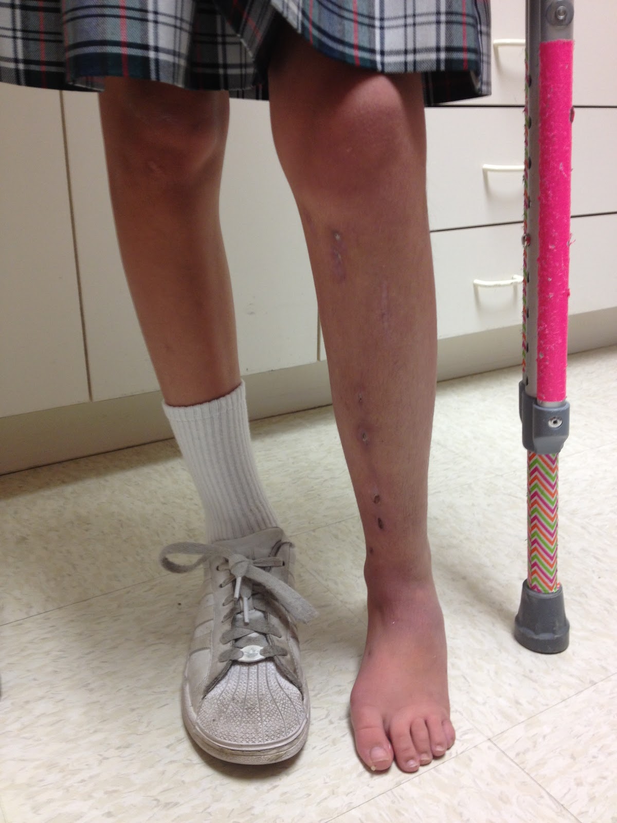 fibular hemimelia leg lengthening: No Fixator! No Cast! Her leg is FREE!!!