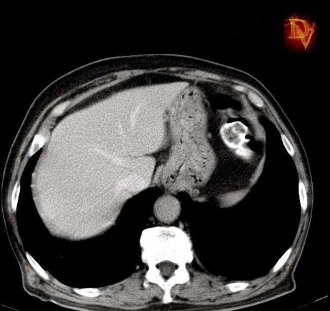 Ultimate Radiology : Hiatus Hernia