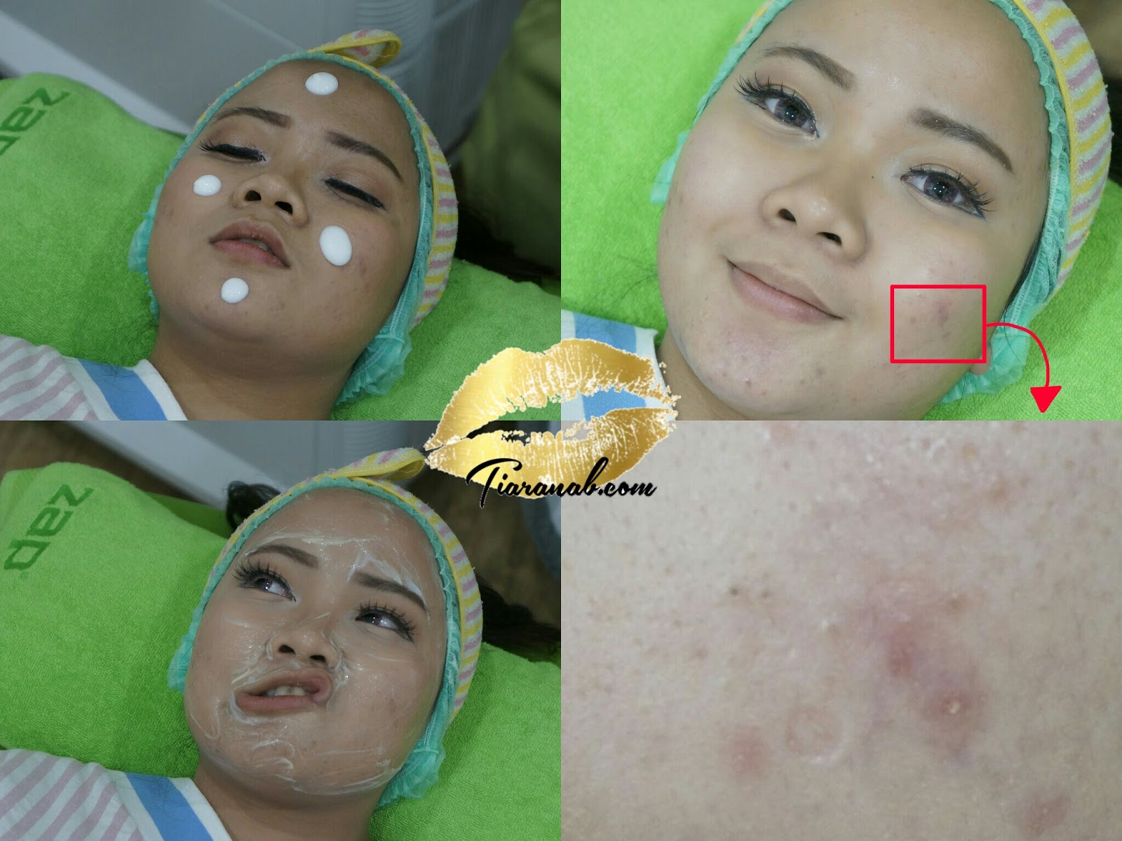 [Beauty Report + Review ] ZAP PREMIER & ZAP Photo Facial Review | Tiaranab