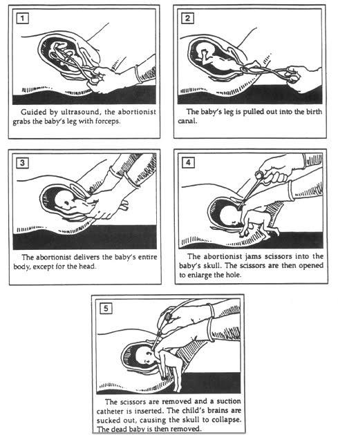 Free For Health: Abortion