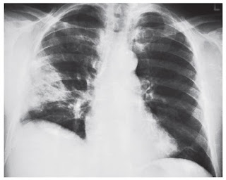 aayusha: pulmonary embolism - the great masquerader