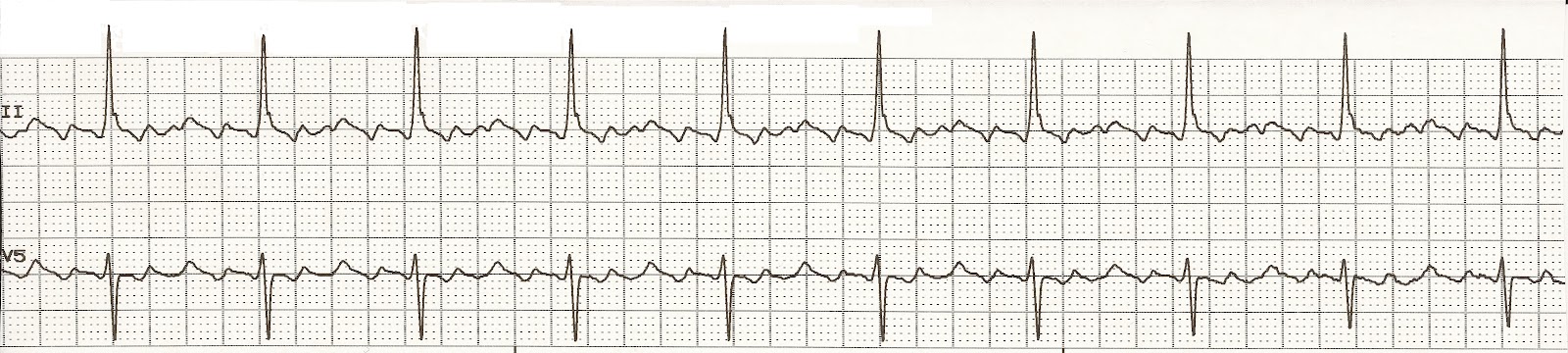EKG Rhythm Strip Quiz 45