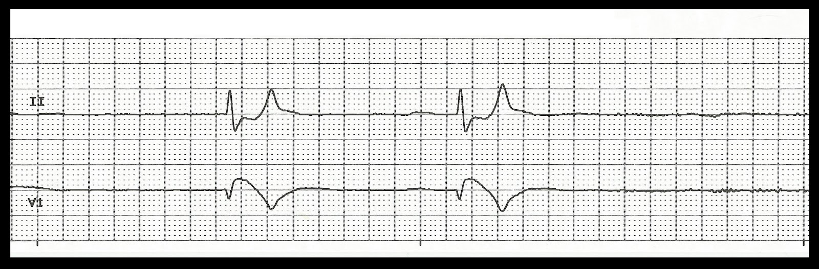 Basic EKG Rhythm Test 11