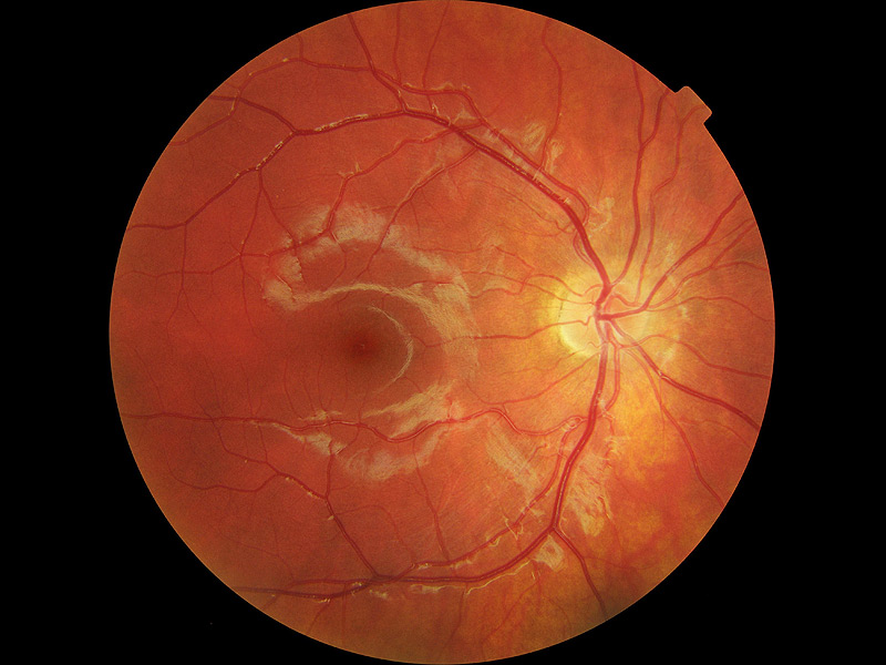 Health Train Express Age Related Macular Degeneration Health Train Express Age Related Macular Degeneration