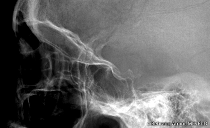 Roentgen Ray Reader: Shallow Sella Turcica
