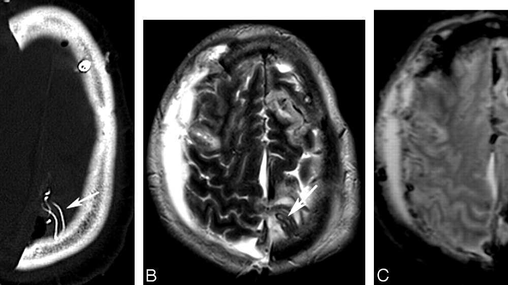 Retained surgical instruments